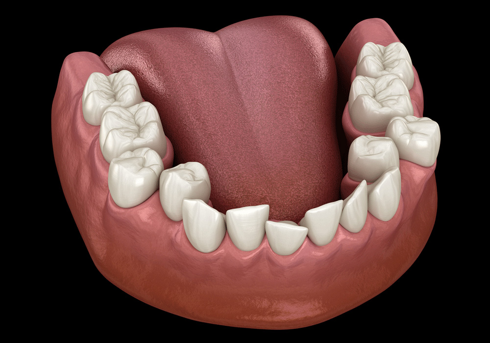 Crowding and Spacing Correction - Lakeside Dental and Wellness